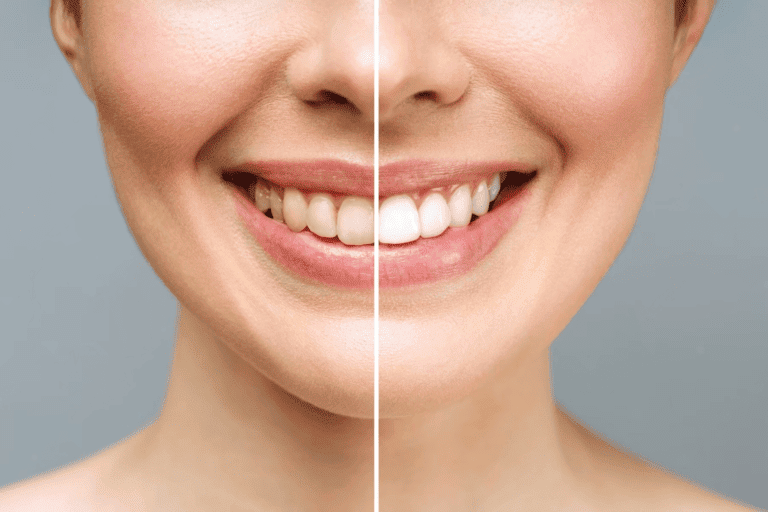Teeth Whitening - Kitcha Dental Clinic Chiang Mai