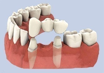 Dental Bridges - Kitcha Dental Clinic Chiang Mai