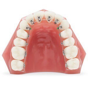 Lingual Braces - Kitcha Dental Clinic Chiang Mai