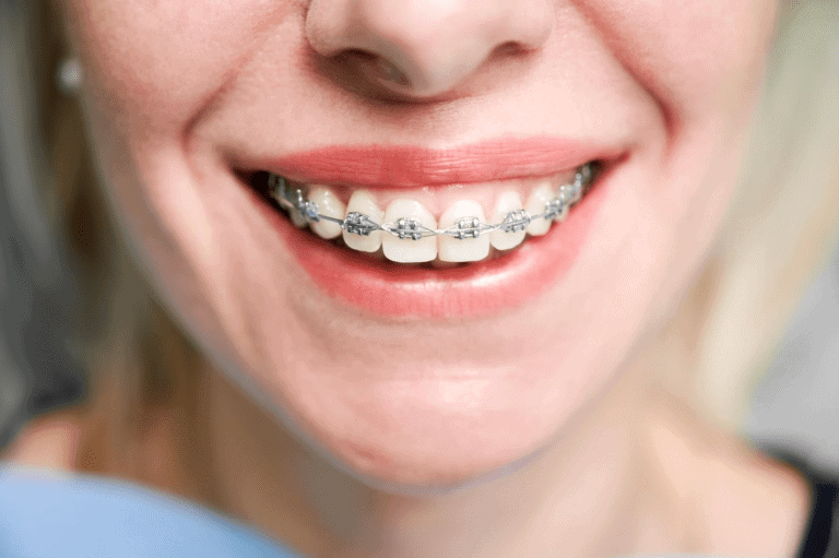 Lingual Braces - Kitcha Dental Clinic Chiang Mai