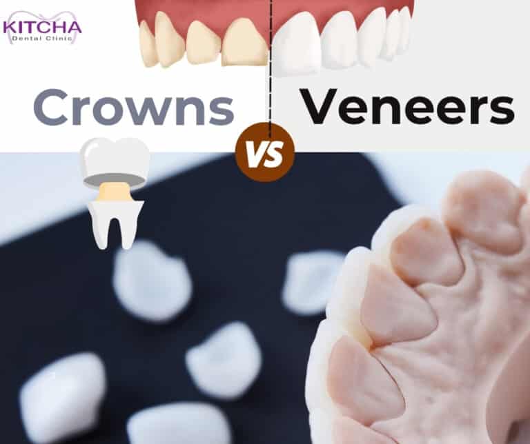 Crowns VS. Veneers
